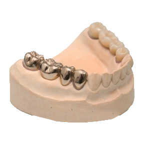 Prothese-conjointe-acier – Biodenthese